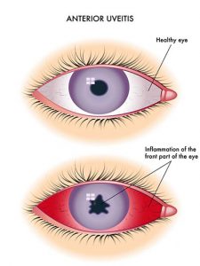 Uveitis, Eye Inflammation · Best Rated NYC Eye Doctor · Ophthalmologist