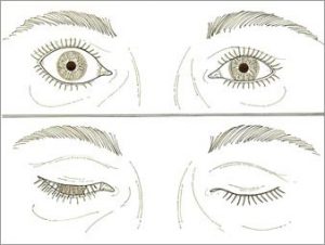 Eyelid Retraction, Lid Surgery · Top Rated NYC Eye Doctor, Midtown NYC