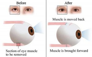 Lazy Eye Surgery · Top Eye Specialist · Best Rated NYC Ophthalmologist