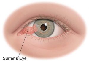 Surfer’s Eye · Top Rated Eye Doctor · Ophthalmologist, Optometrist NYC